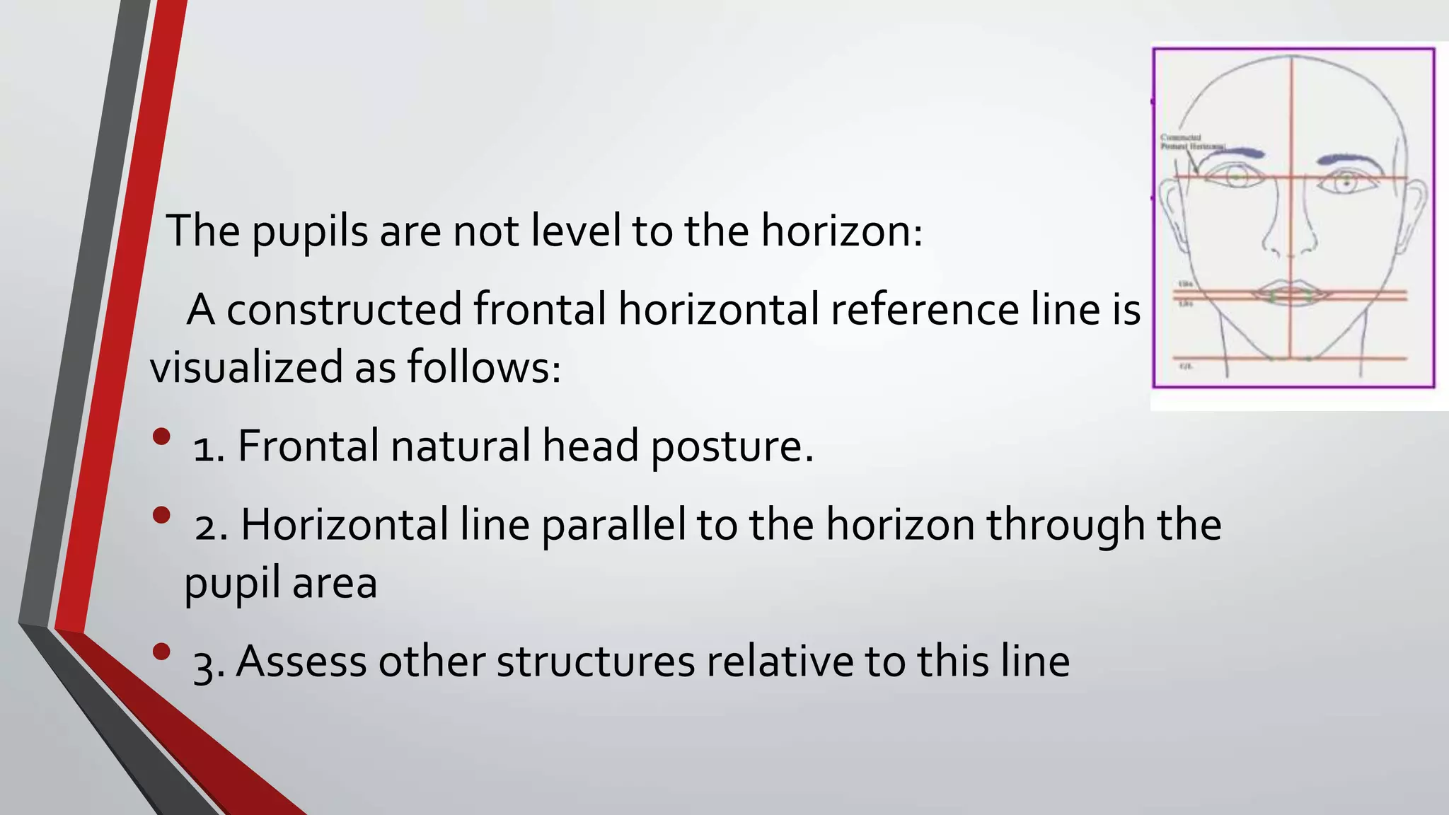 Management of Facial asymmetry | PPTX