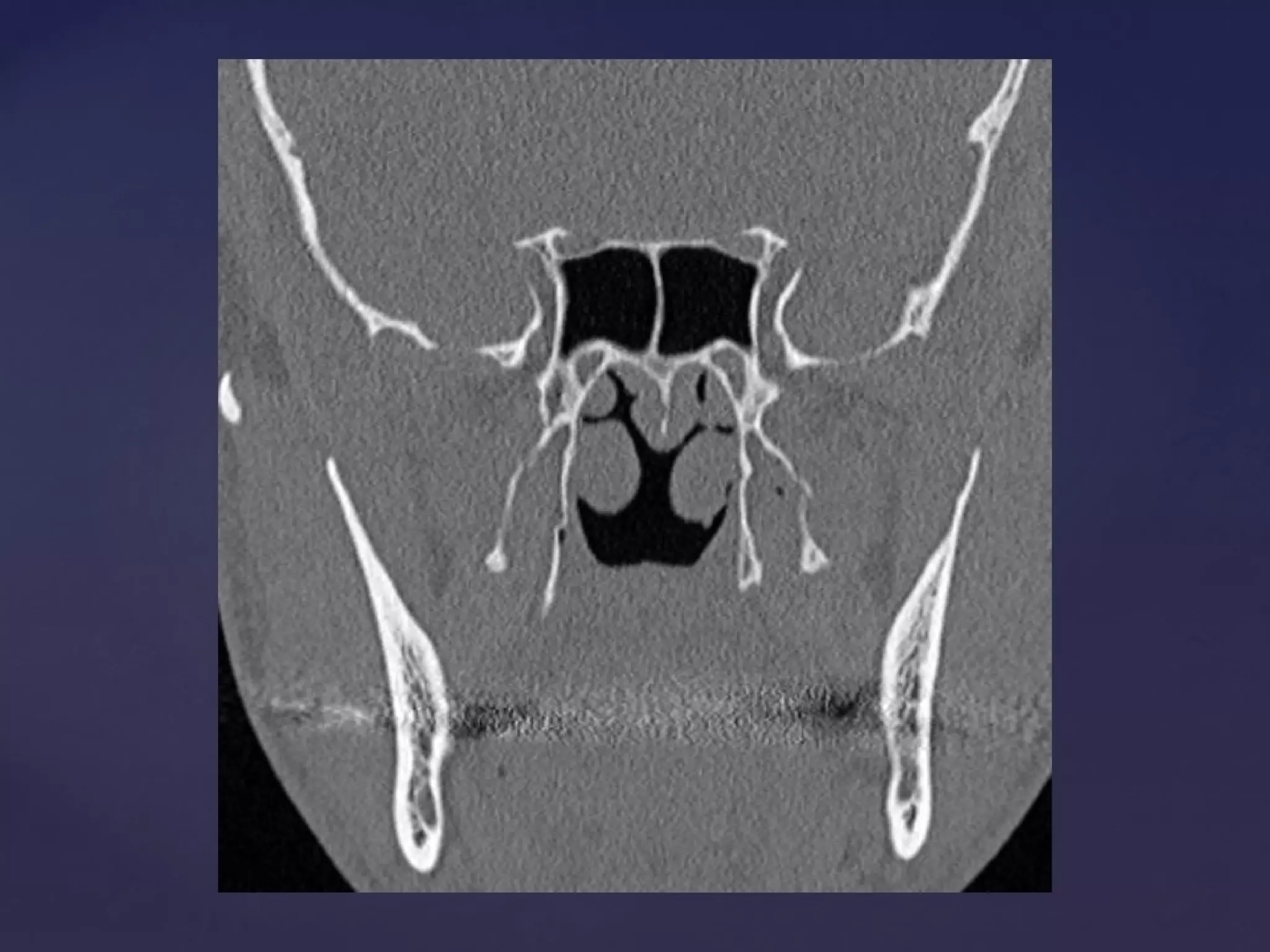 Facial bone fracture | PPT