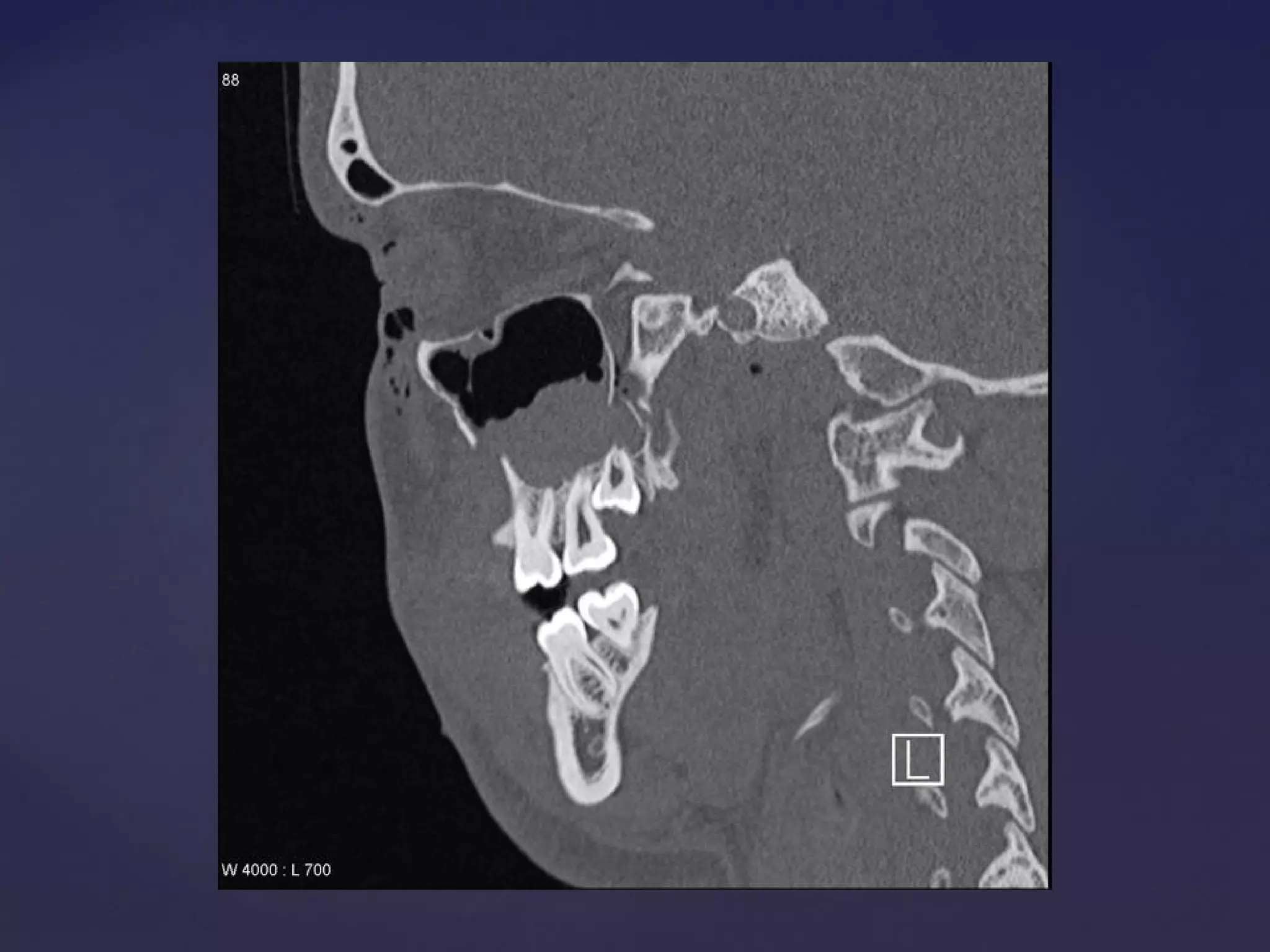 Facial bone fracture | PPT