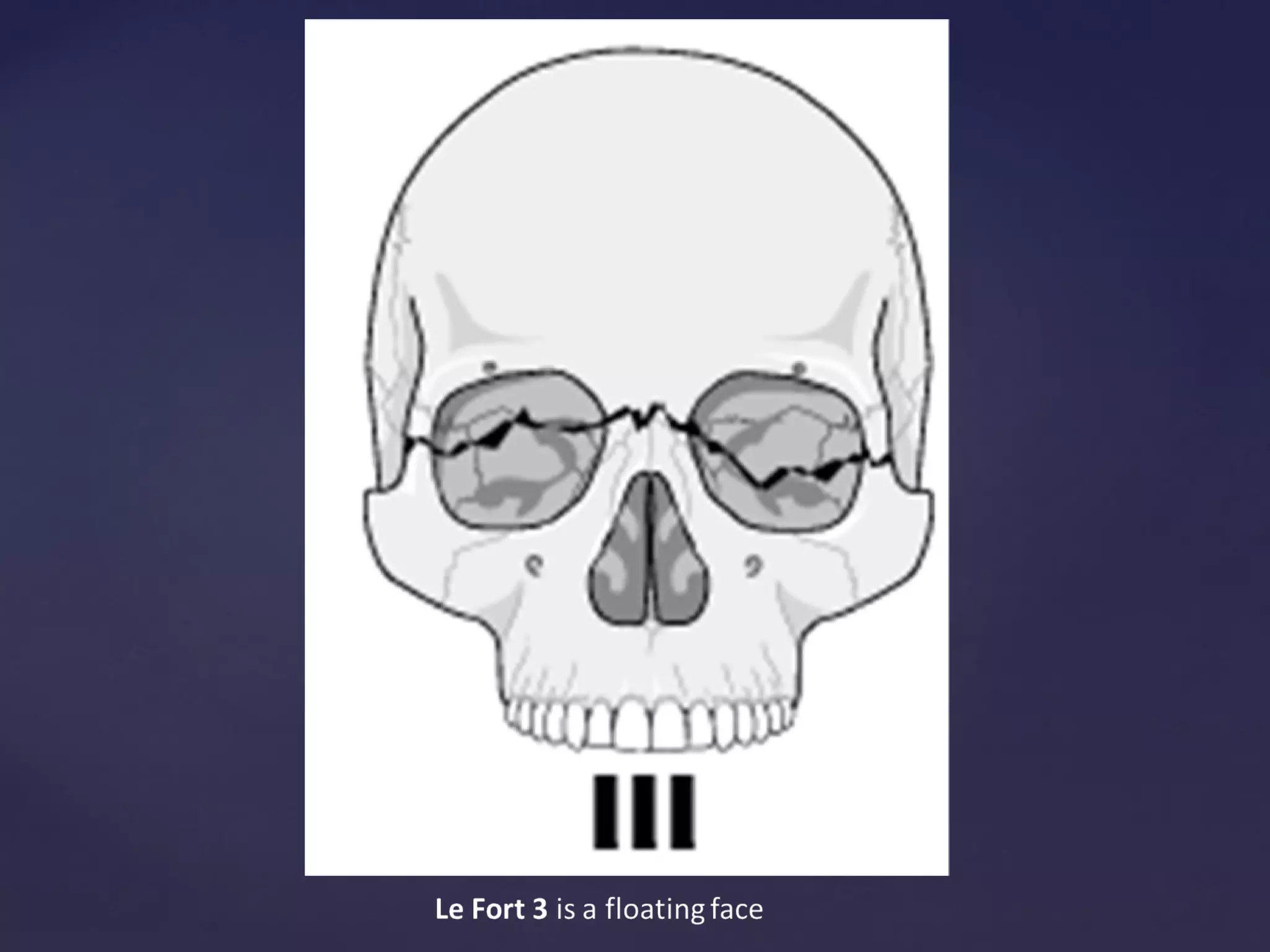 Facial bone fracture | PPT