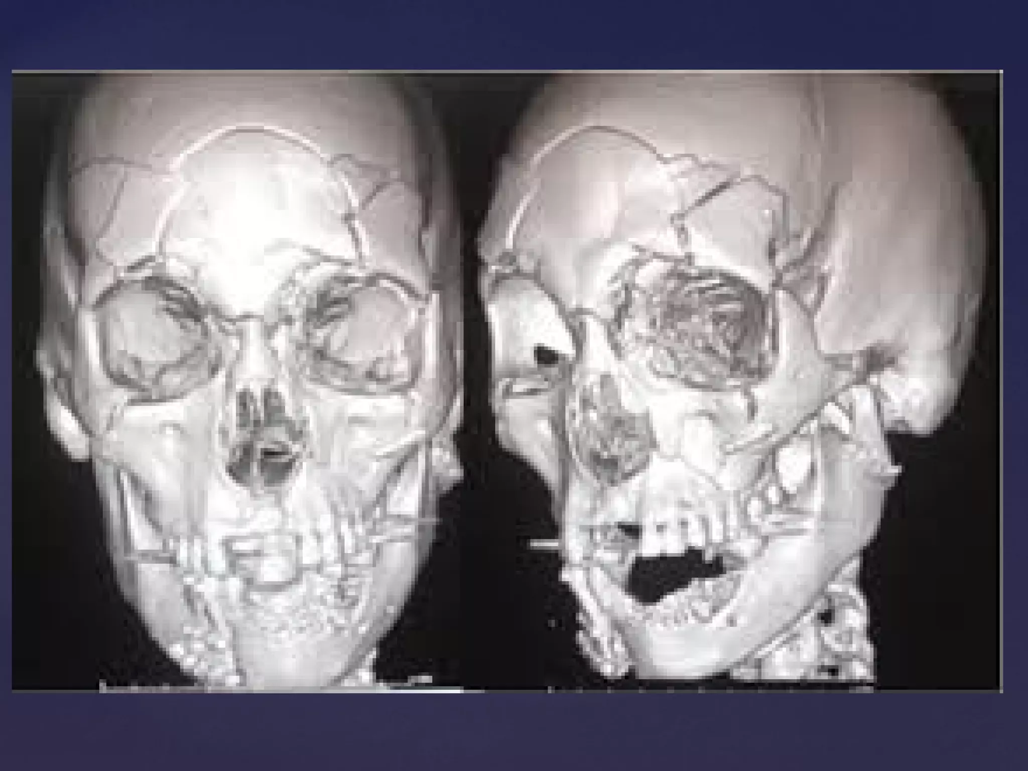Facial bone fracture | PPT