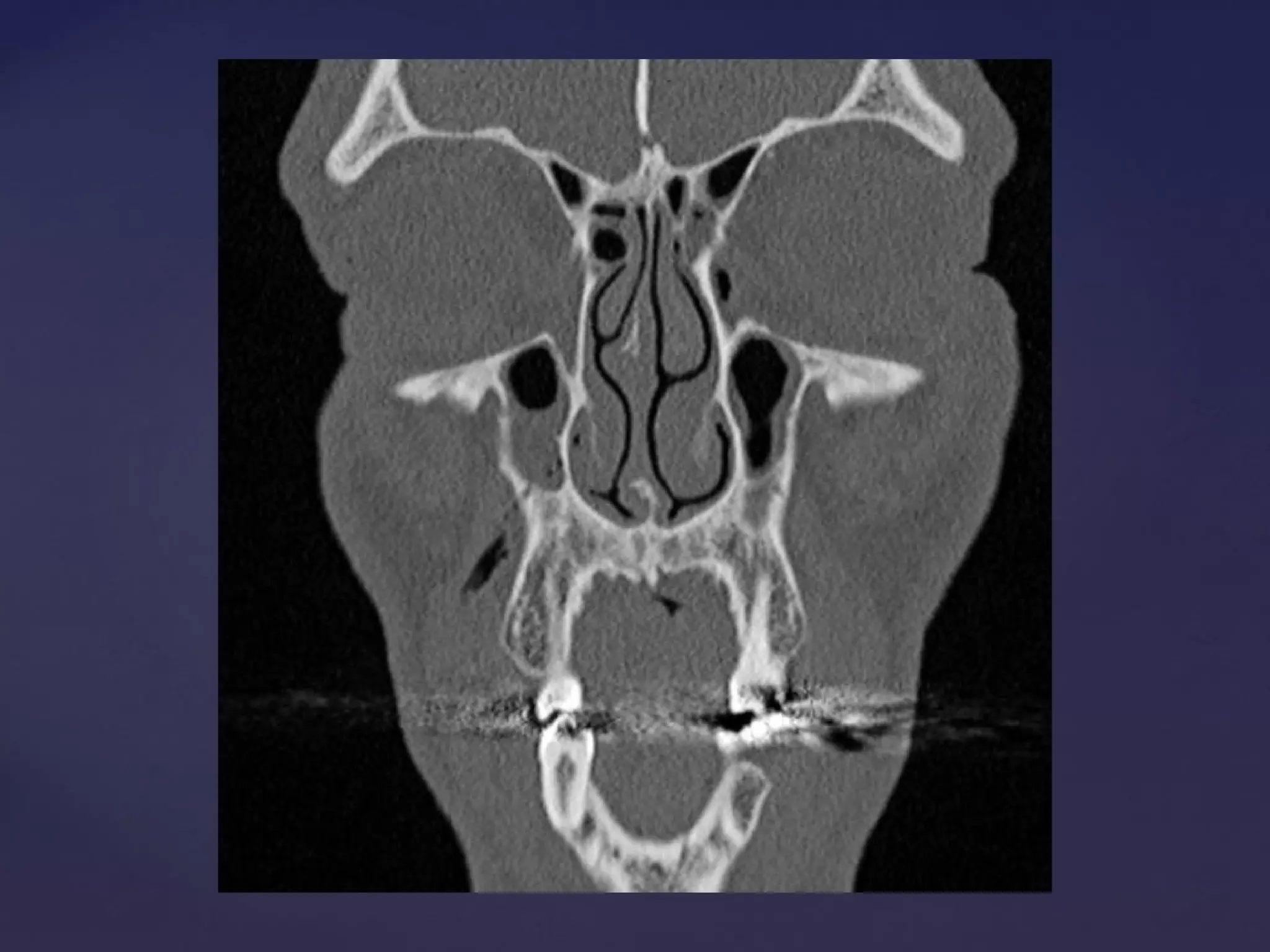 Facial bone fracture | PPT