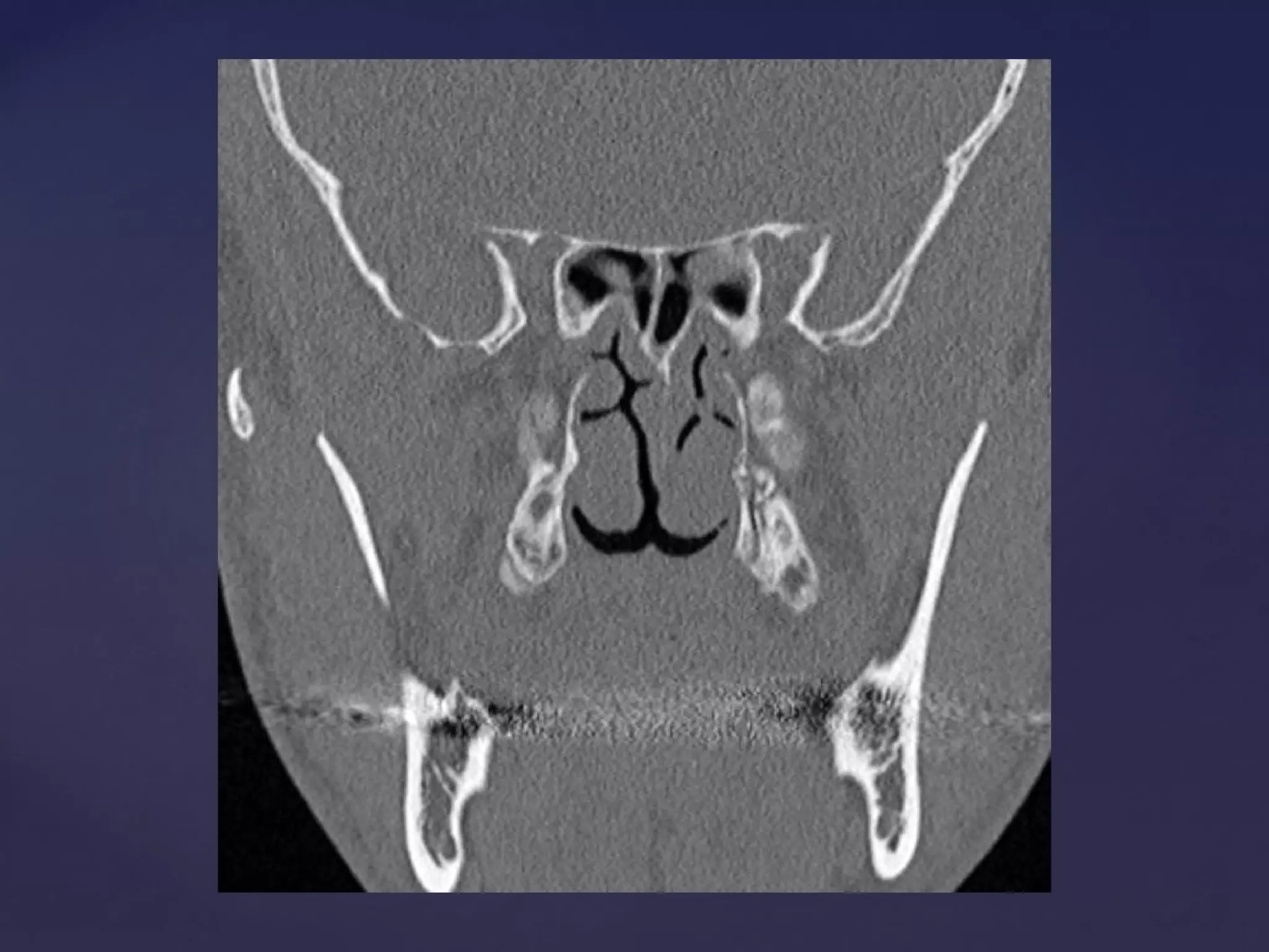 Facial bone fracture | PPT