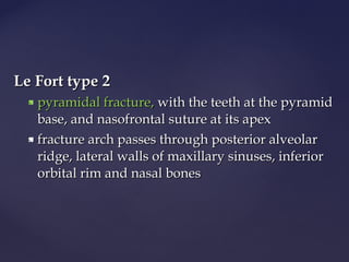 Facial bone fracture | PPT
