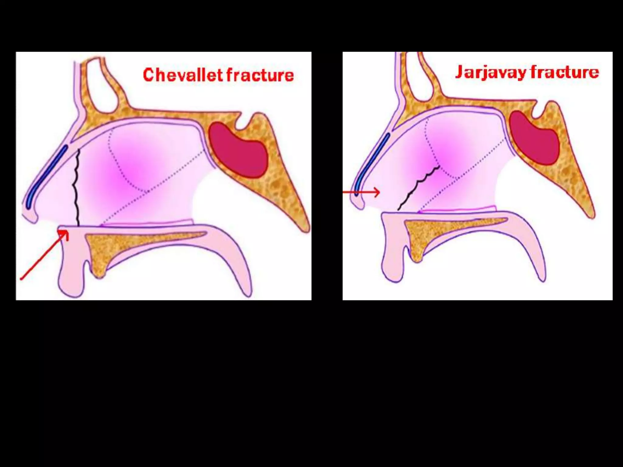 Facial bone fractures | PPT