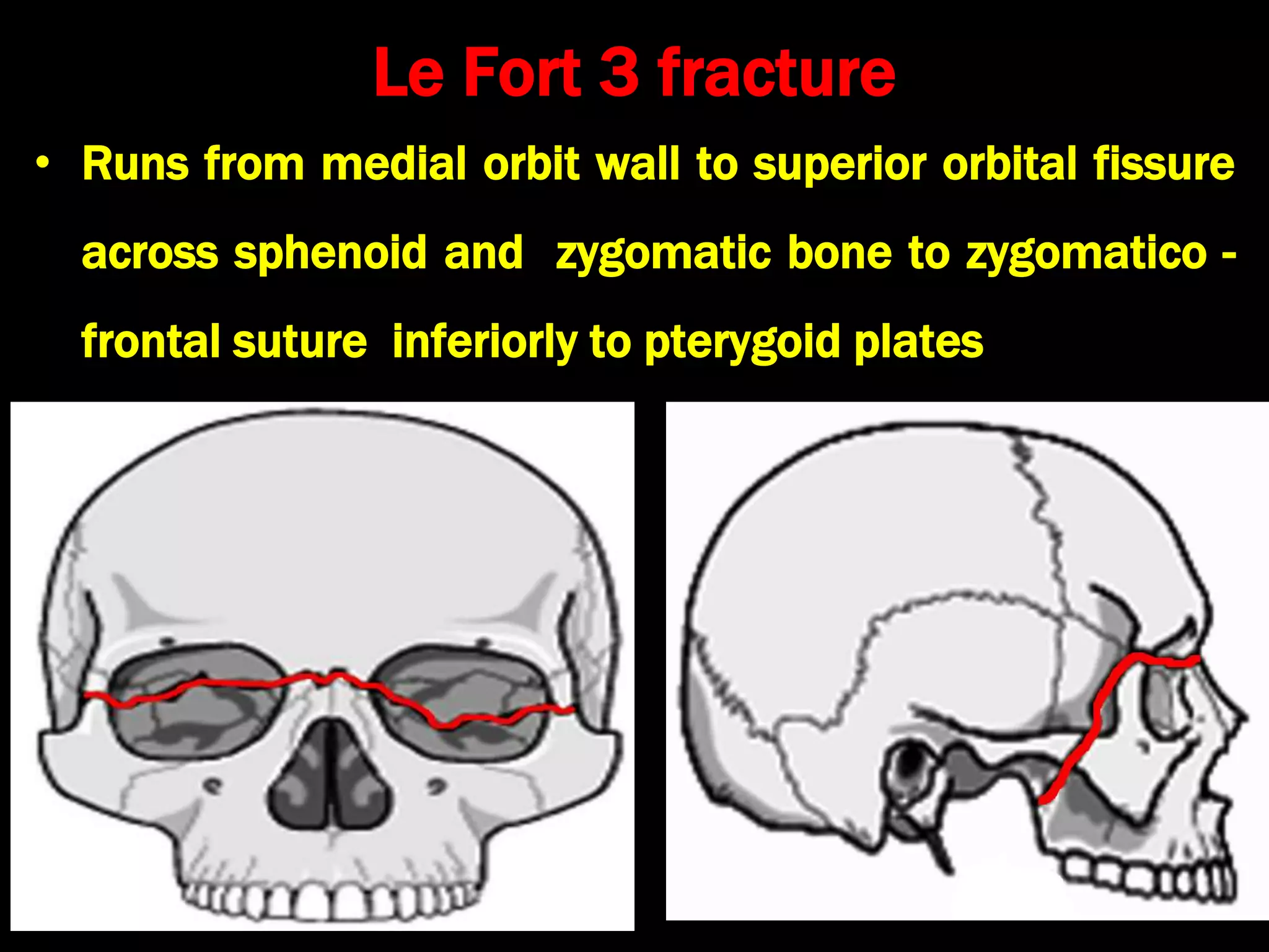Facial bone fractures | PPT