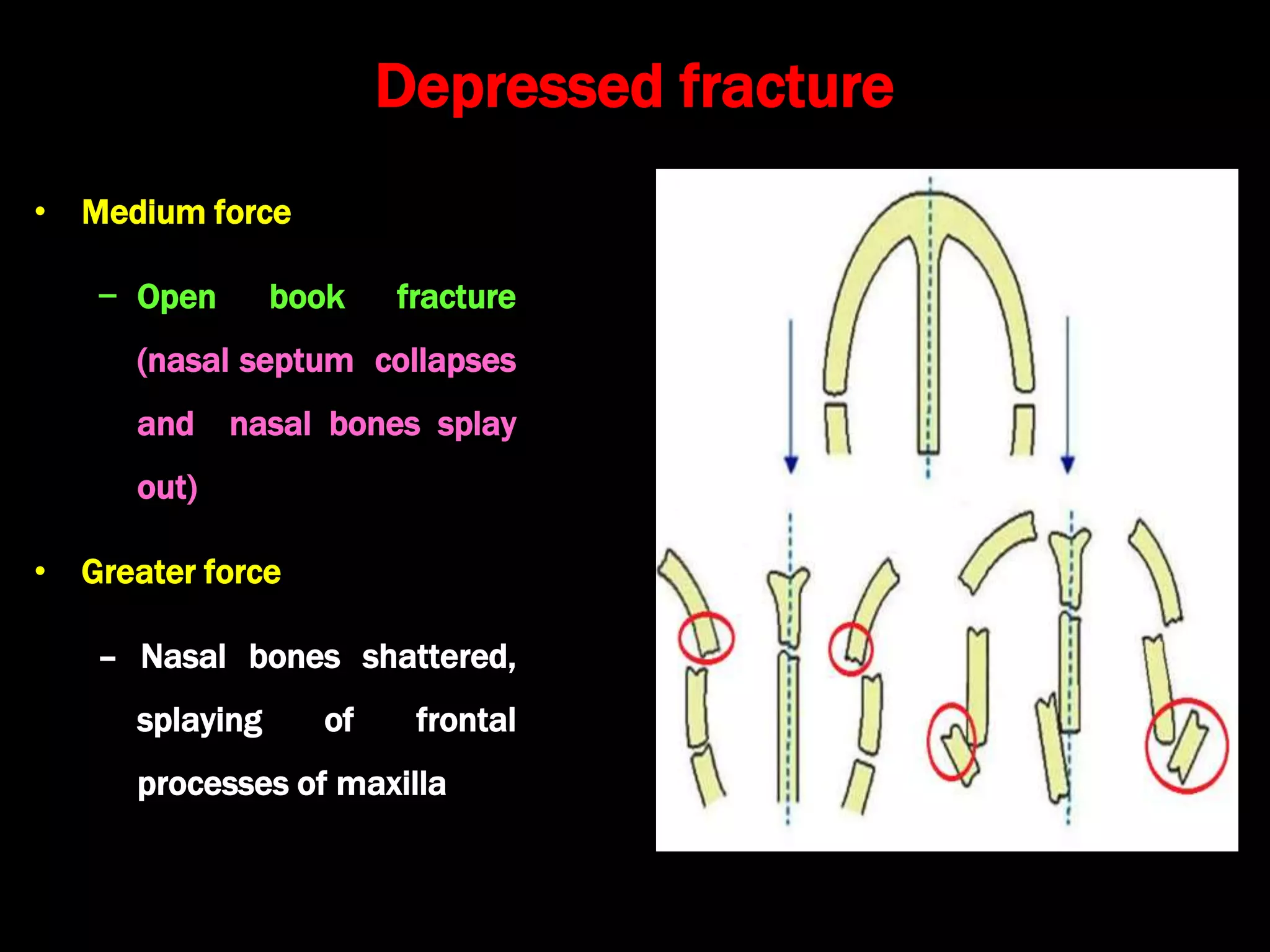 Facial bone fractures | PPT