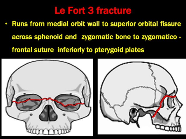 Facial bone fractures | PPT | Death, Injury, or Military Conflict ...