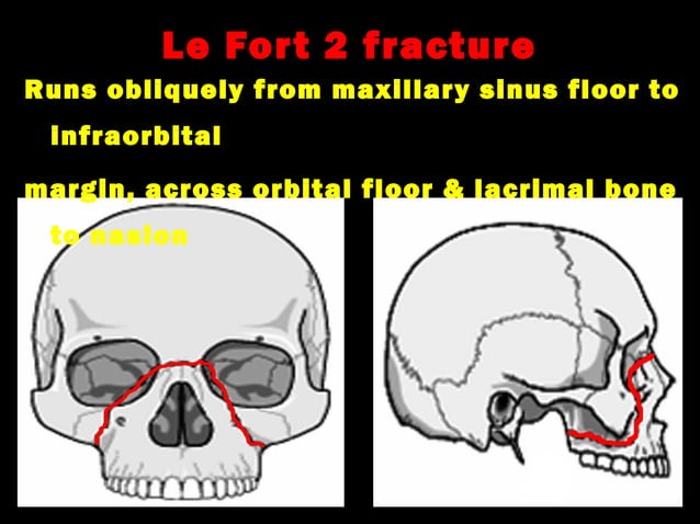 Facial bone fractures by dr sarthak gupta.pdf