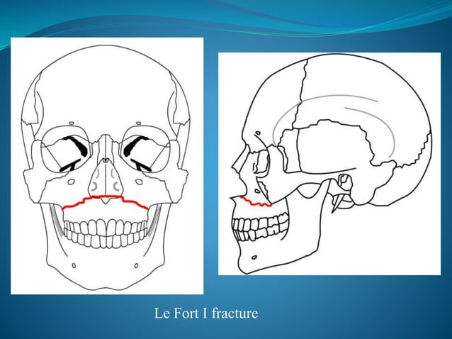Facial bone fractures an overview | PPTX | Death, Injury, or Military ...