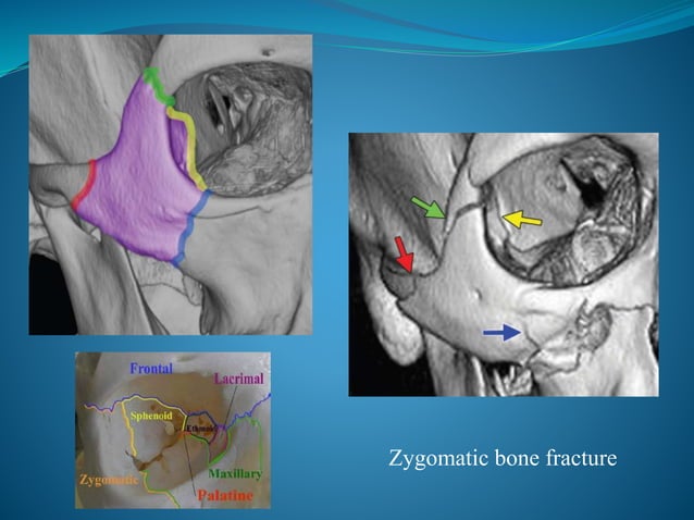 Facial bone fractures an overview | PPTX | Death, Injury, or Military ...