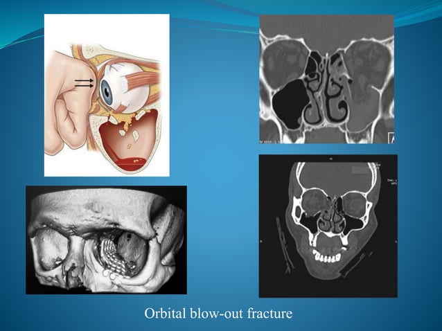 Facial bone fractures an overview | PPT