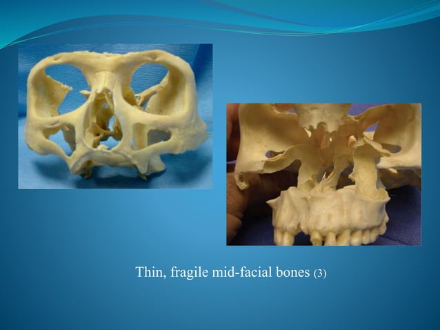 Facial bone fractures an overview | PPTX | Death, Injury, or Military ...