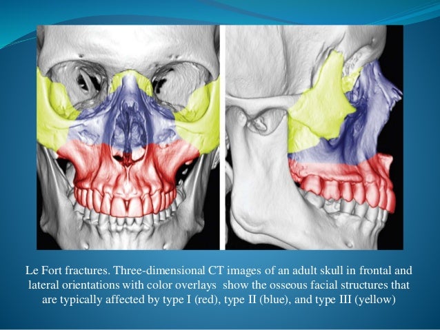 Facial bone fractures an overview