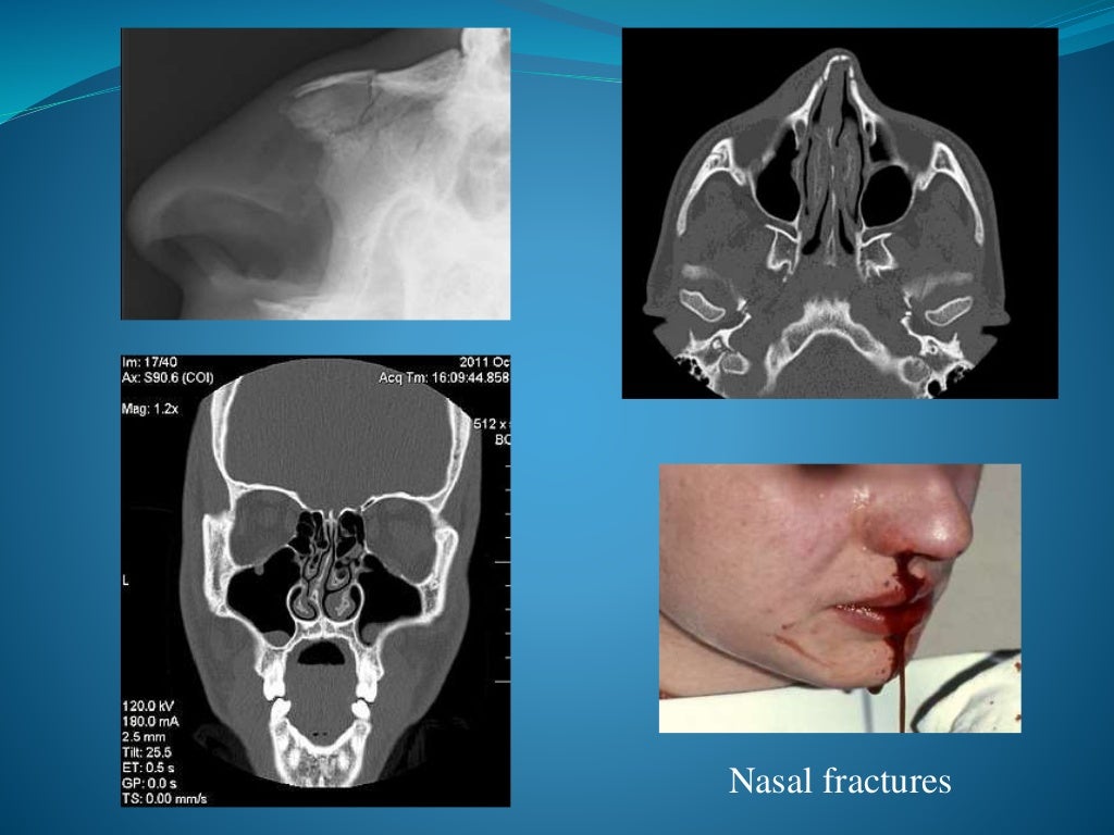 Facial bone fractures an overview