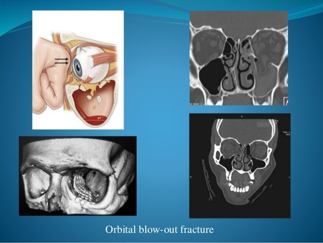 Facial bone fractures an overview