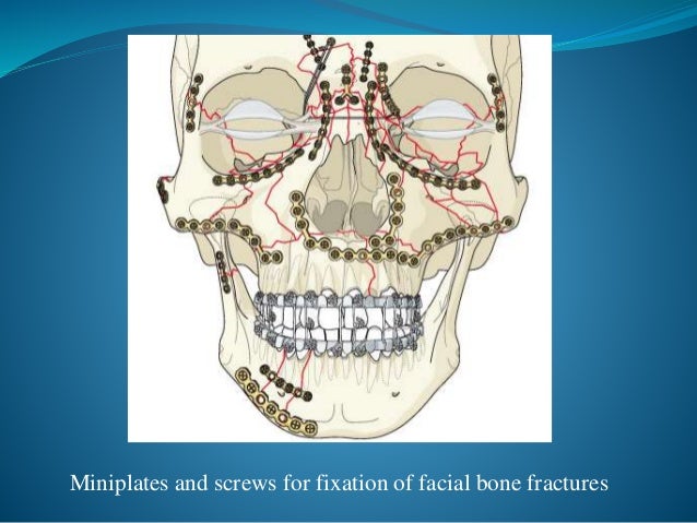 Facial bone fractures an overview