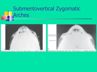 Submentovertical Zygomatic Arches