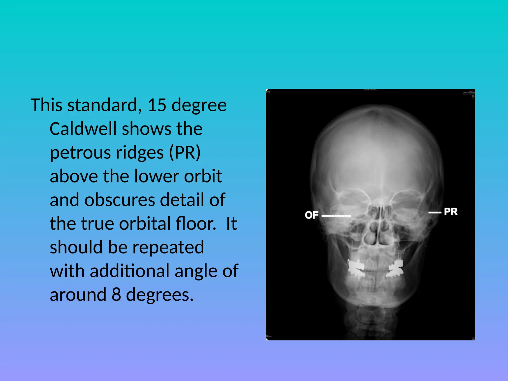- SURGICAL Facial_Bones_Power_Point_pptx.pptx