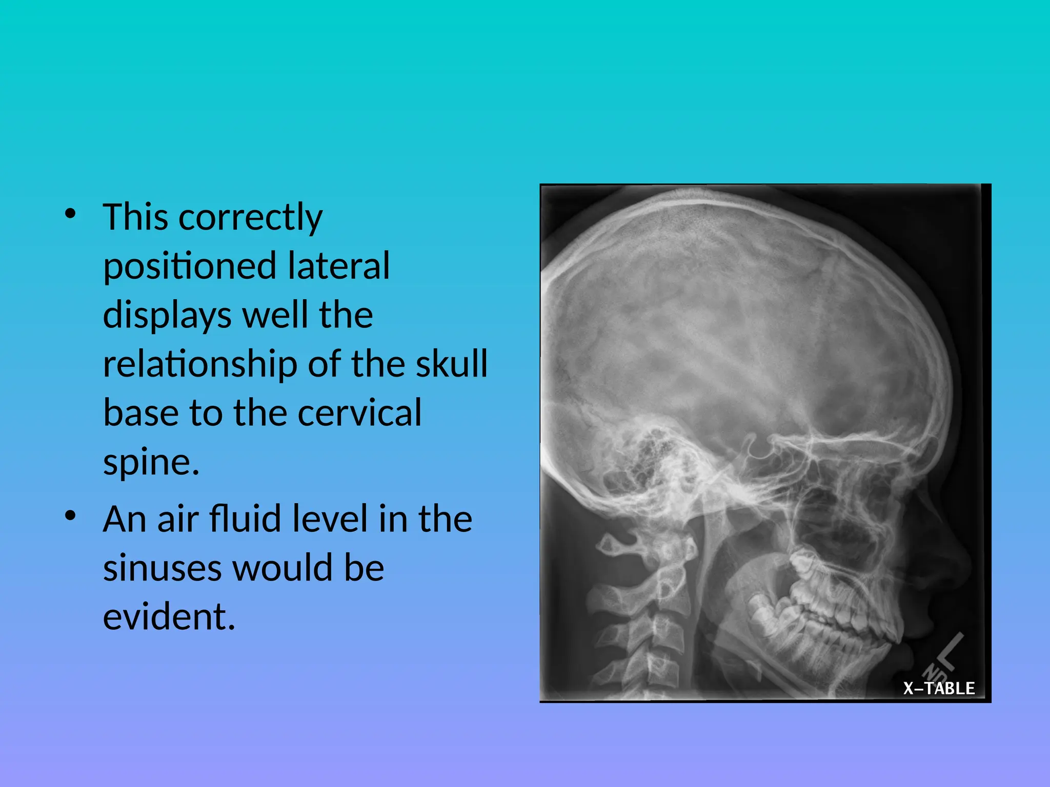 - SURGICAL Facial_Bones_Power_Point_pptx.pptx