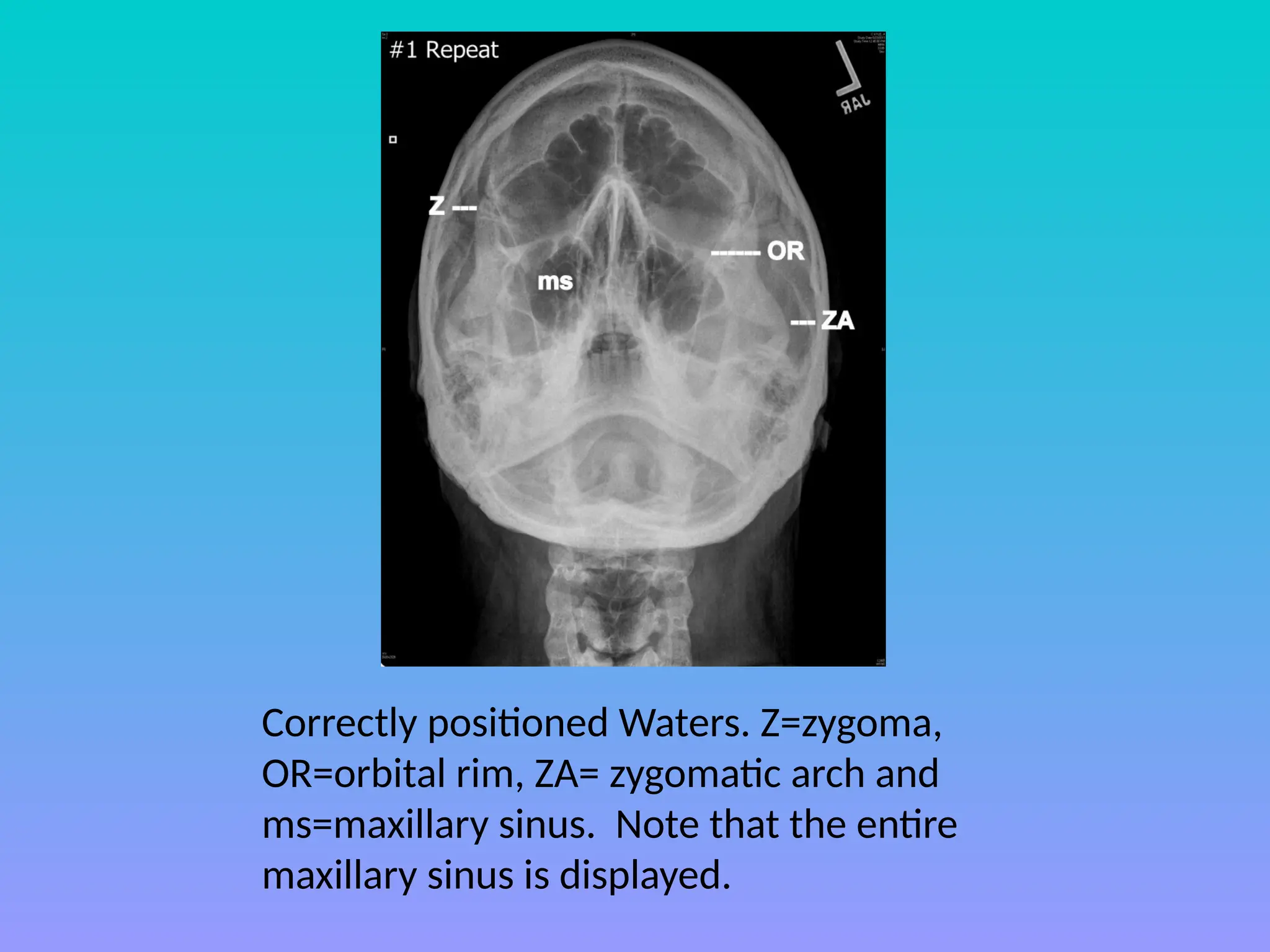- SURGICAL Facial_Bones_Power_Point_pptx.pptx