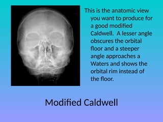- SURGICAL Facial_Bones_Power_Point_pptx.pptx