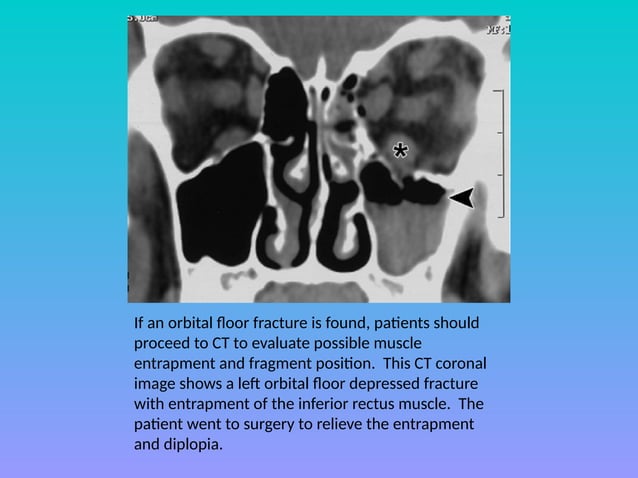 - SURGICAL Facial_Bones_Power_Point_pptx.pptx