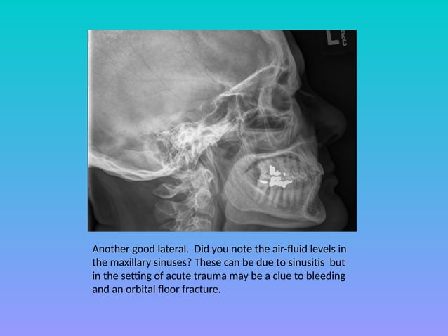 - SURGICAL Facial_Bones_Power_Point_pptx.pptx