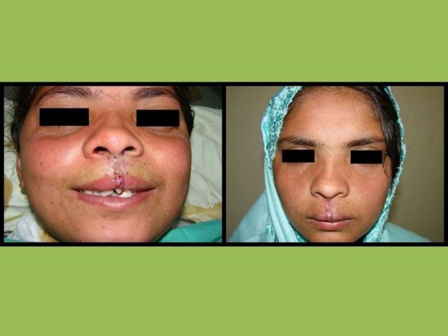 Facial clefts 0 to 7 | PPT