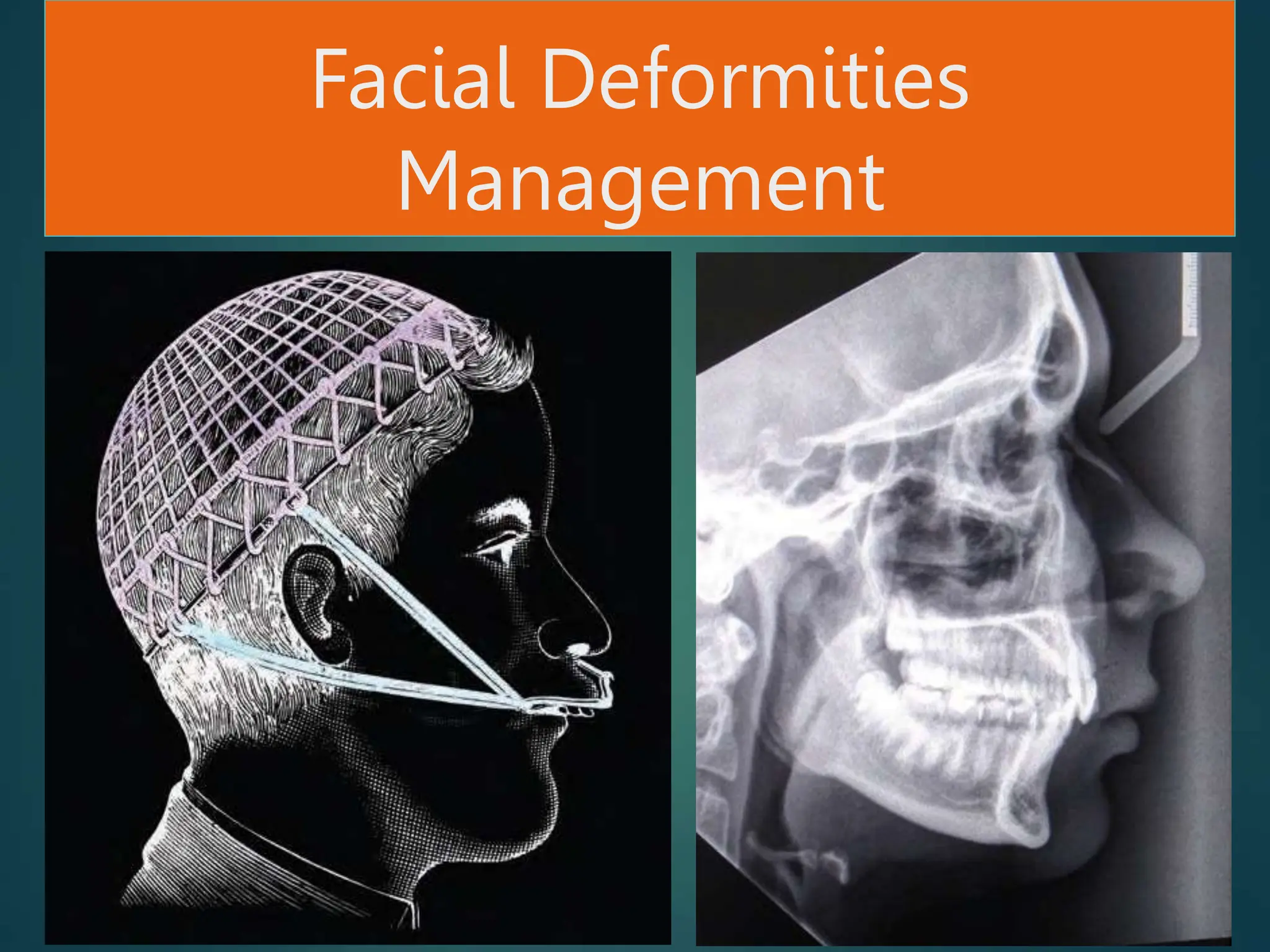Facial Deformities Management Orthognathic Surgery From Diagnosis To