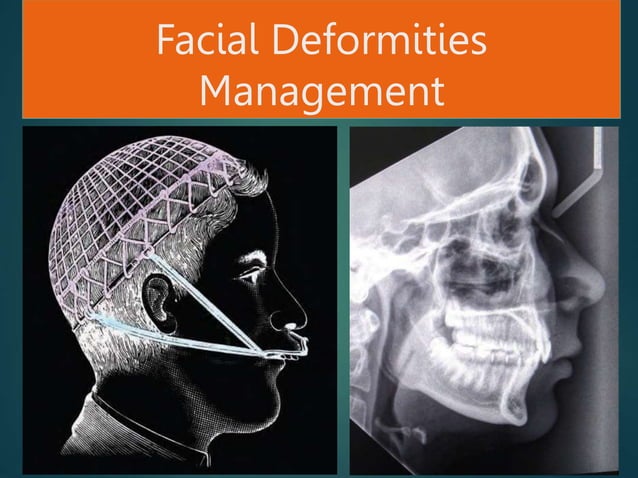 Facial Deformities Management: Orthognathic Surgery From Diagnosis to ...
