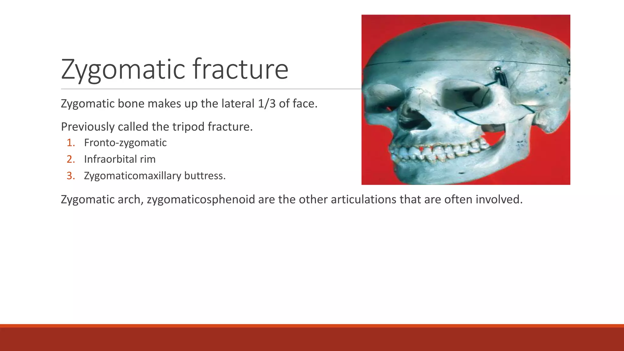 Facial fracture | PPTX