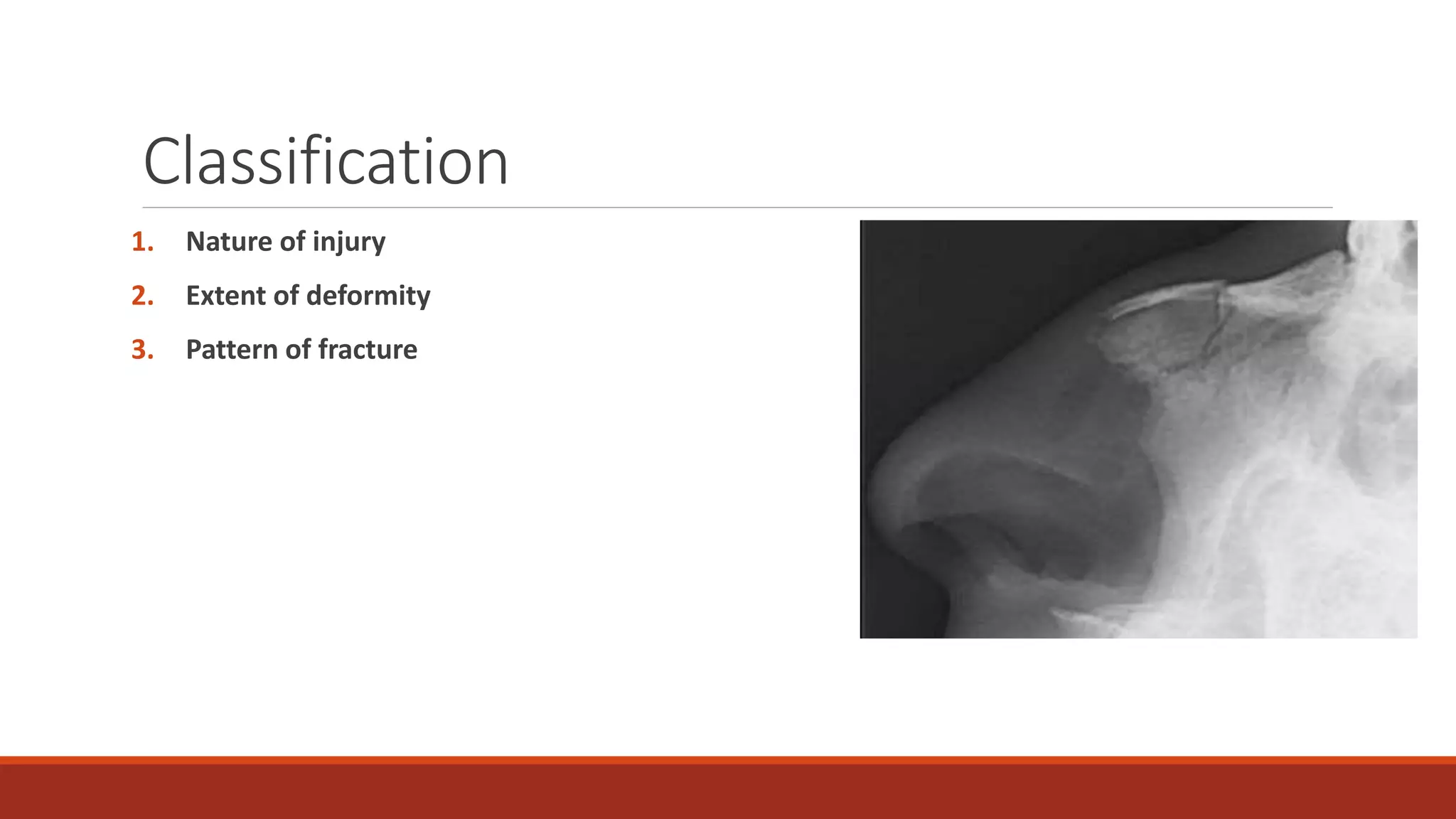Facial fracture | PPTX