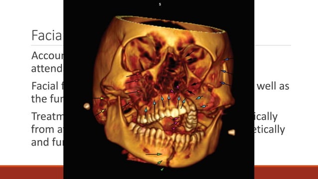 Facial fracture | PPTX
