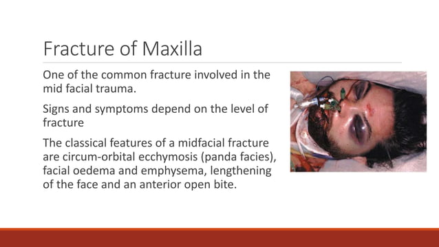 Facial fracture | PPTX