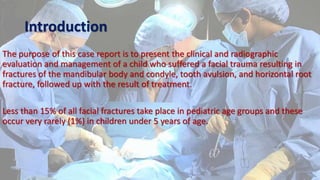 Facial fractures (Case Report) | PPTX
