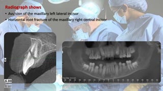 Facial fractures (Case Report) | PPTX
