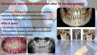 Facial fractures (Case Report) | PPTX