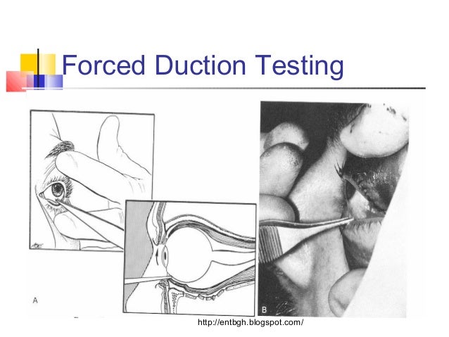 Facial fractures the upper face