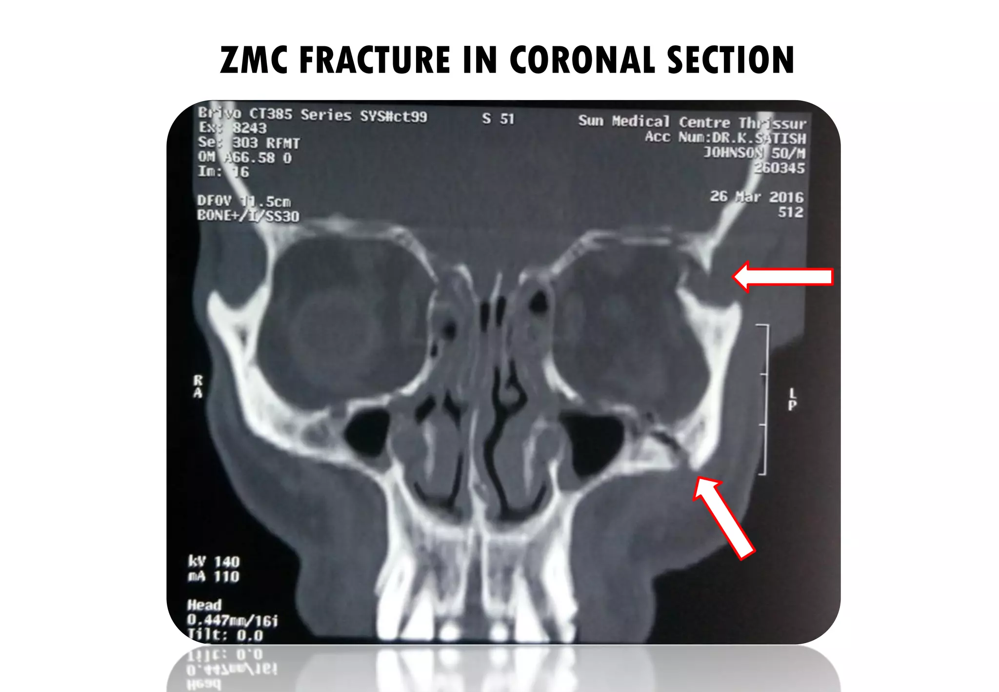 Radiographs in Oral and Maxillofacial Surgery / Facial fractures made ...