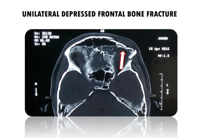 Radiographs in Oral and Maxillofacial Surgery / Facial fractures made ...