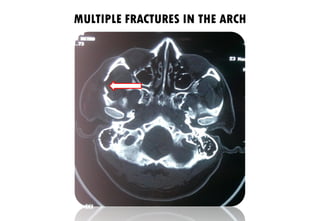 Radiographs in Oral and Maxillofacial Surgery / Facial fractures made ...