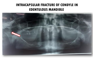 Radiographs in Oral and Maxillofacial Surgery / Facial fractures made ...