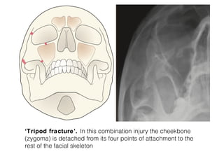 Management of Facial Fractures in ED | PPT