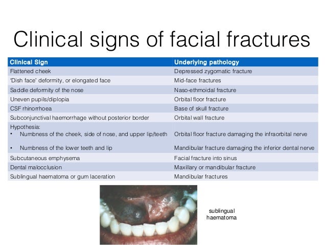 Management Of Facial Fractures In Ed