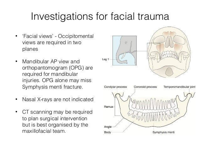 Management of Facial Fractures in ED