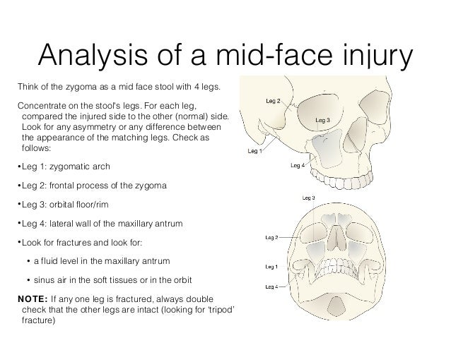 Management of Facial Fractures in ED