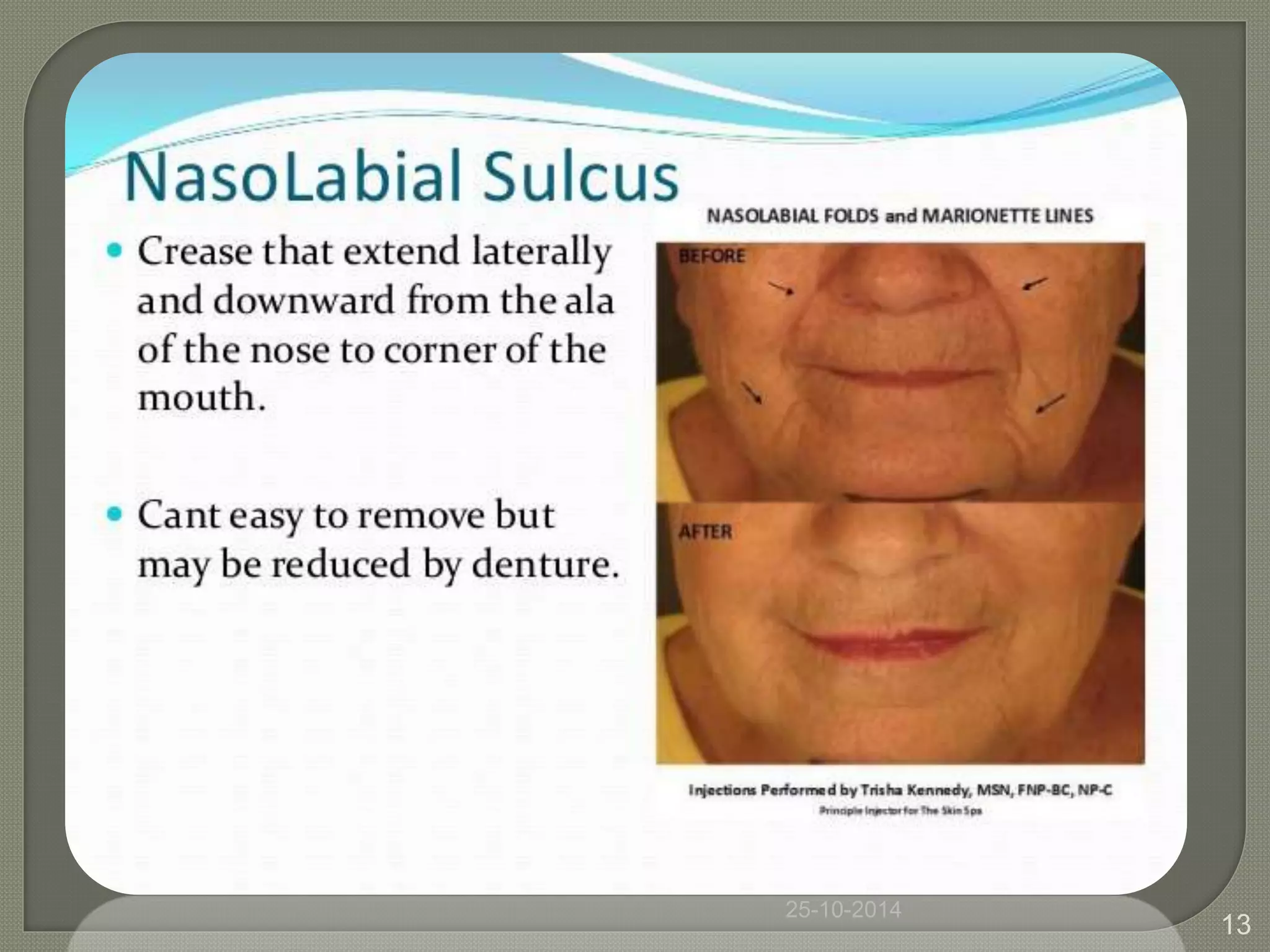 Facial landmarks & its role in prosthodontics | PPTX