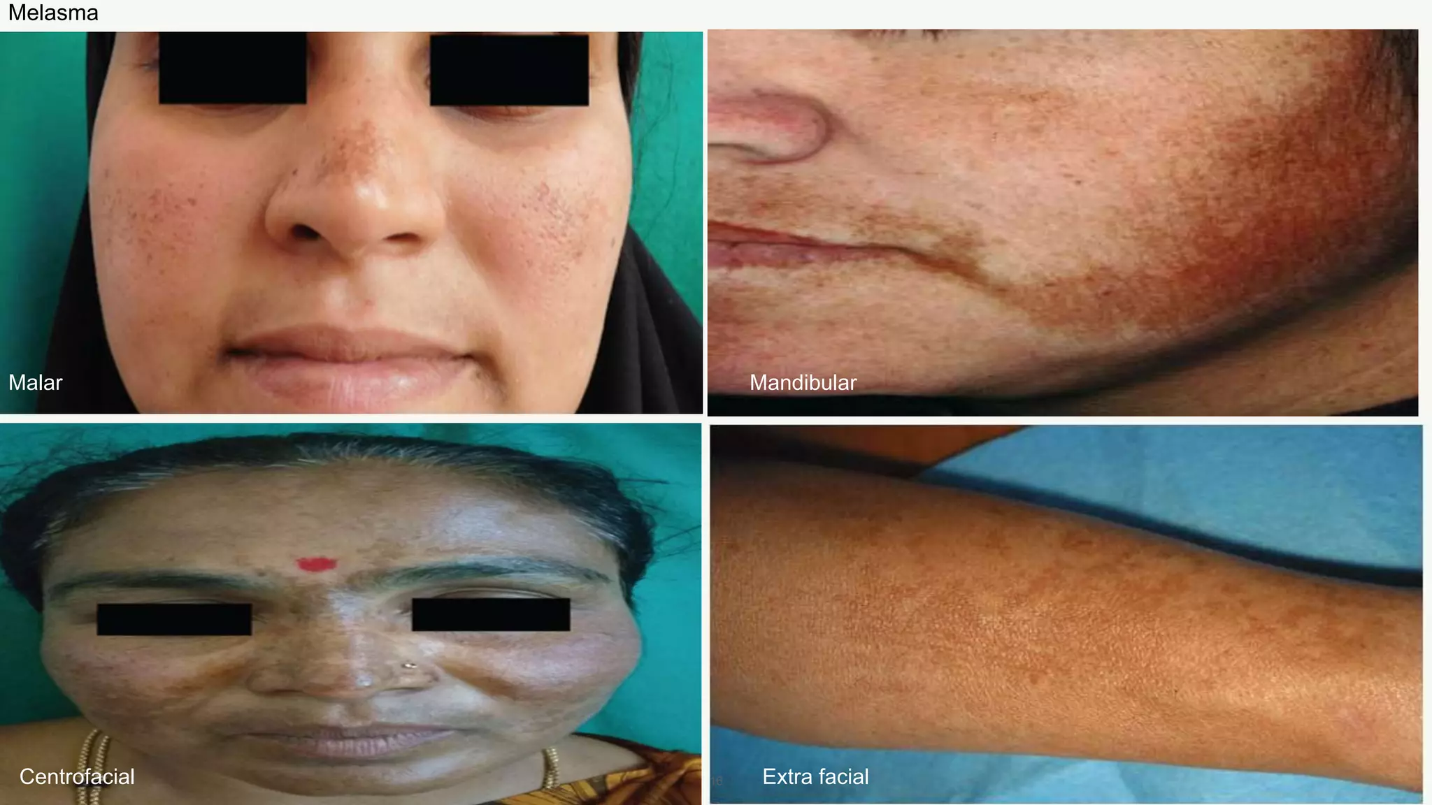 Facial Melanosis.pptx