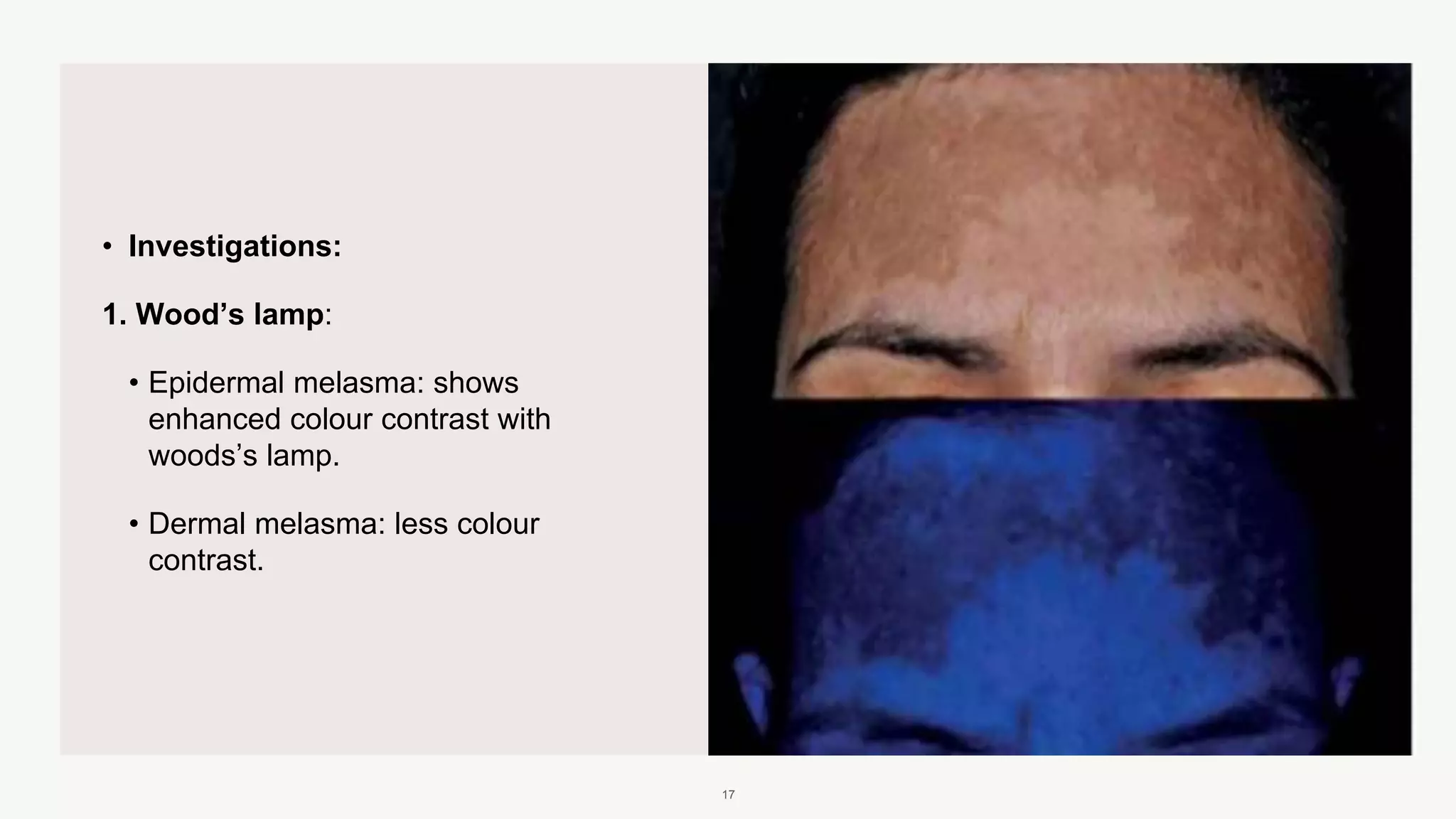 Facial Melanosis.pptx